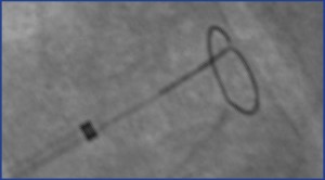 ONE Snare® Endovascular Snare System - Merit Medical