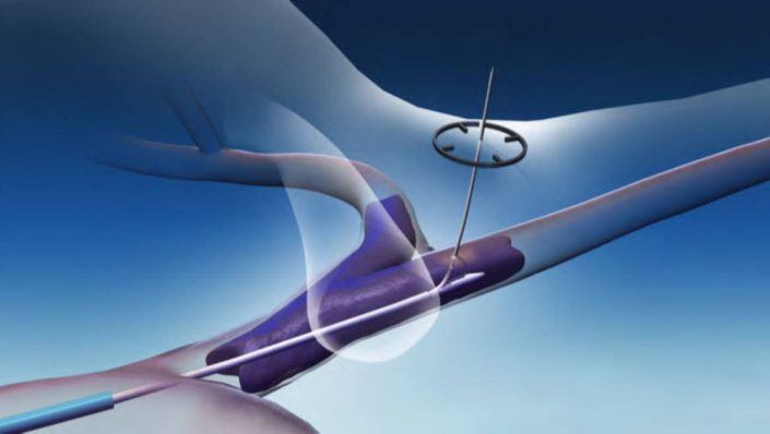 Dialysis Access | Life Changing Solutions | Merit Medical