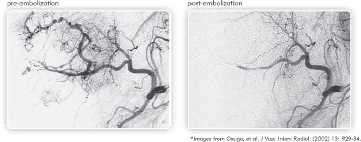 QuadraSphere® Microspheres - Merit Medical