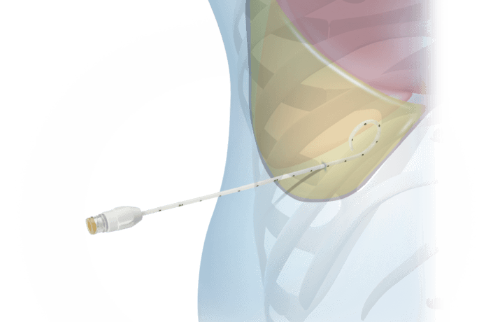 Merit’s Family of Drainage Products Supports Drainage Procedural Needs ...