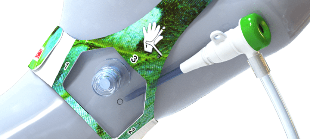 PreludeSYNC DISTAL™ - Merit Medical