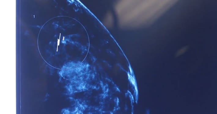 SCOUT® Radar Localization | Tumor Localization | Merit Medical