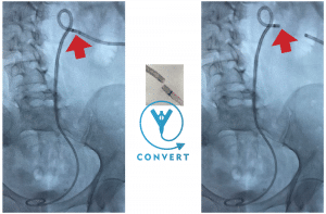ReSolve ConvertX® Nephroureteral & Biliary Stent System - Merit Medical