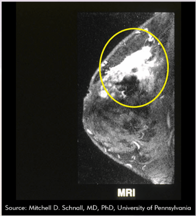 SCOUT® Radar Localization | Tumor Localization | Merit Medical