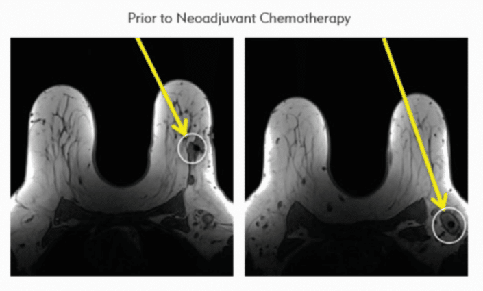 SCOUT® Radar Localization | Tumor Localization | Merit Medical