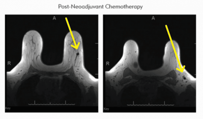 SCOUT® Radar Localization | Tumor Localization | Merit Medical