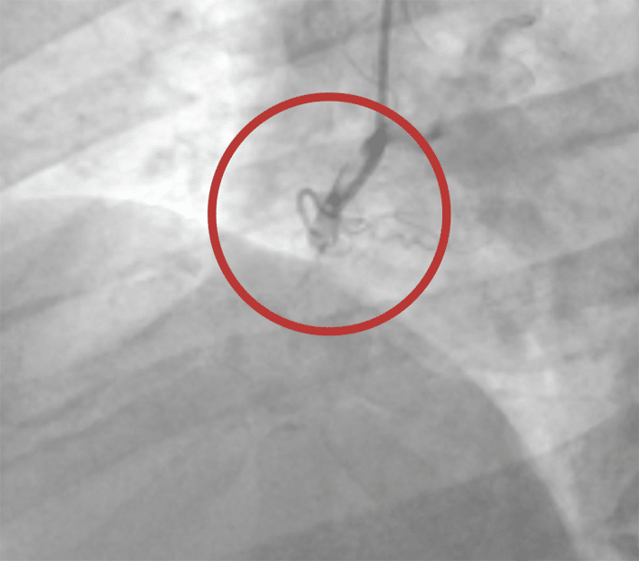 ASAP® & ASAPLP Aspiration Catheters - Merit Medical