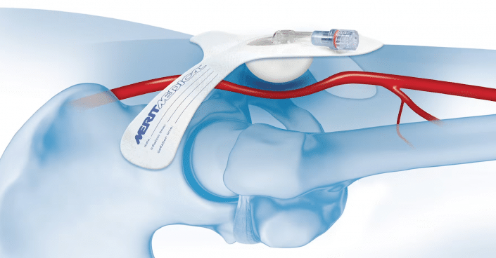 Safeguard Radial™ Compression Device - by Merit