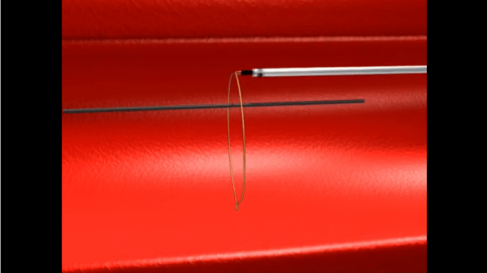 ONE Snare® Endovascular Snare System - Merit Medical