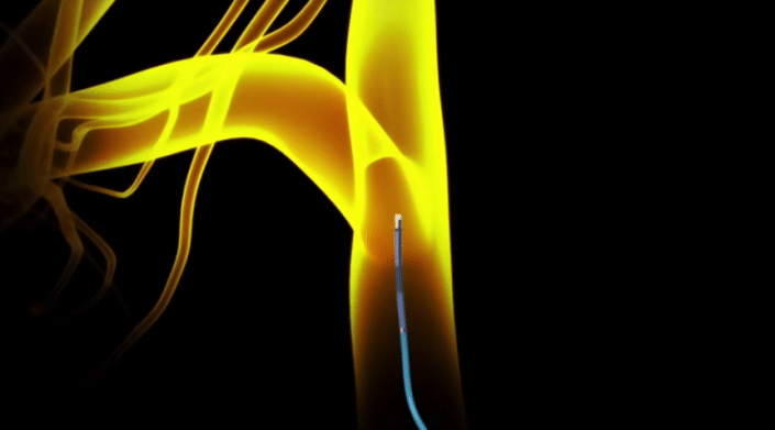 SwiftNINJA Steerable Straight Tip Microcatheter - Merit Medical
