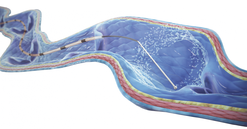 ClariVein® OC Infusion Catheter - Merit Medical