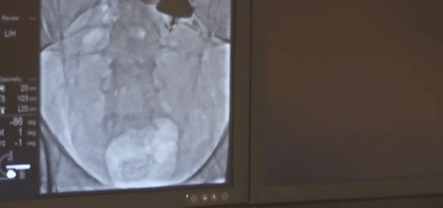 Peritoneal Dialysis (PD) Catheters | Life Improved | Merit Medical