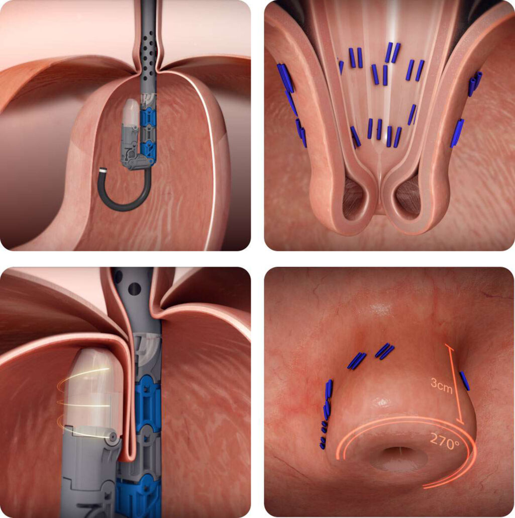 TIF 2.0® by Merit Medical | GERD Treatment | Clinically Proven
